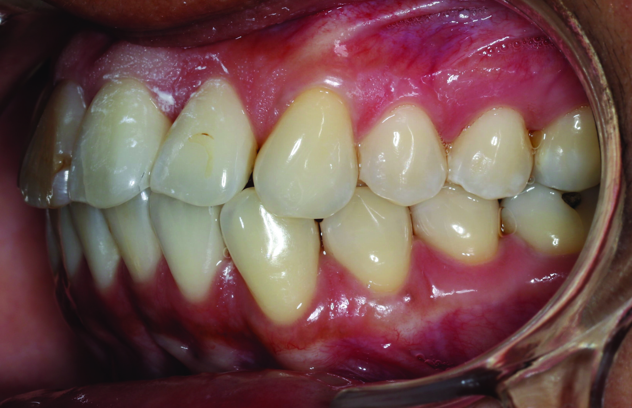 The InBrace System: Orthodontic Treatment on Autopilot