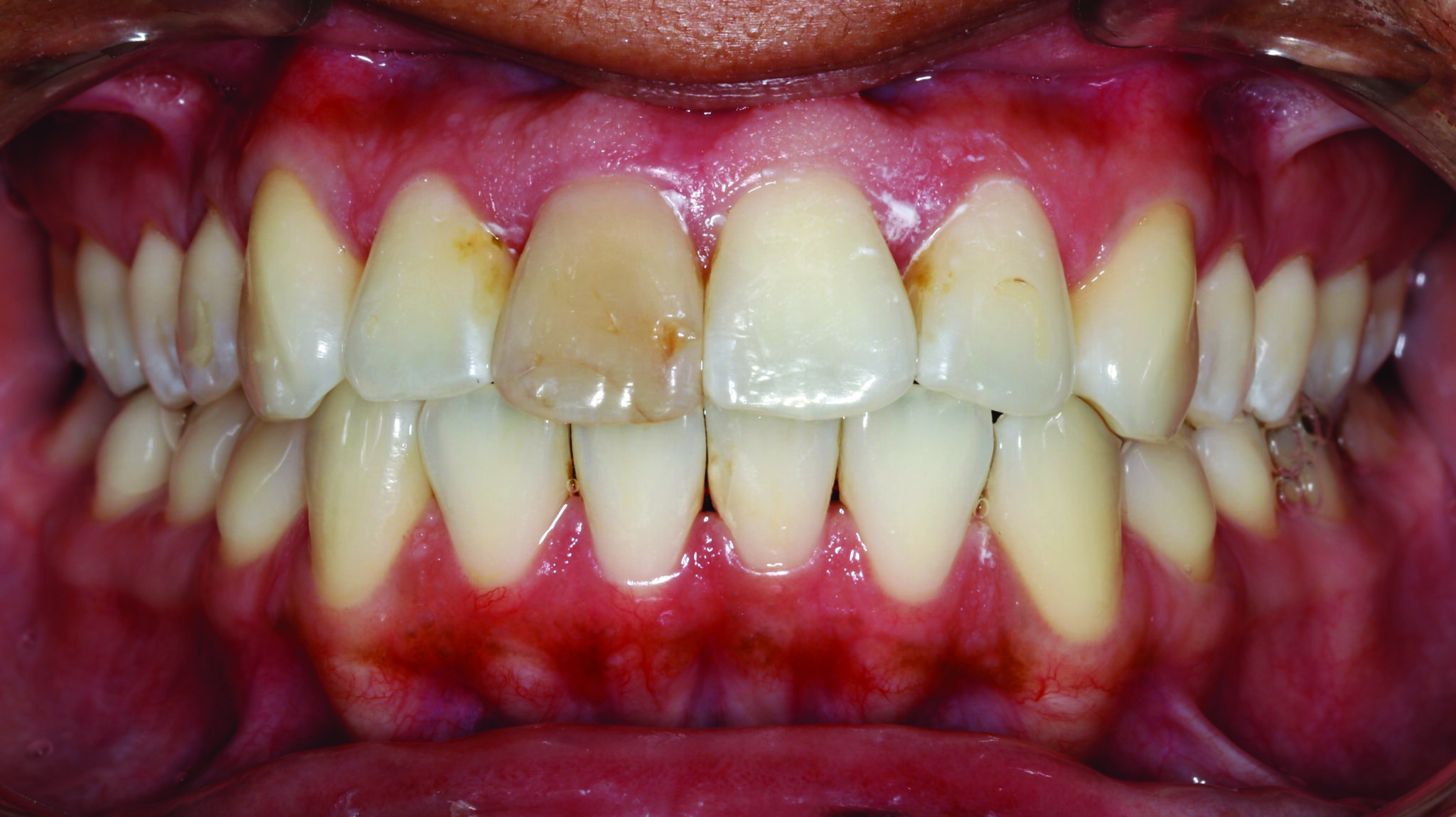 The InBrace System: Orthodontic Treatment on Autopilot