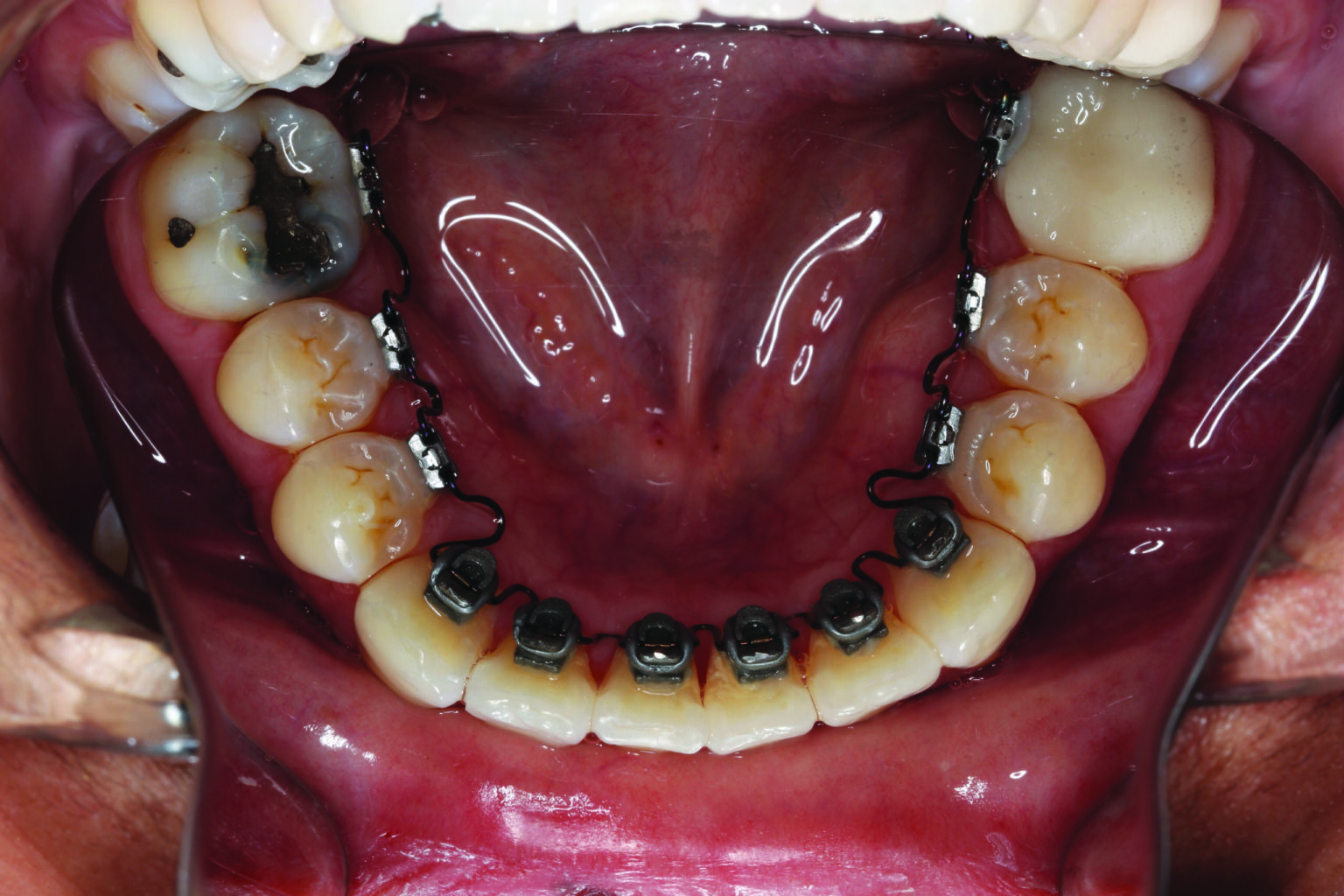 The InBrace System: Orthodontic Treatment on Autopilot