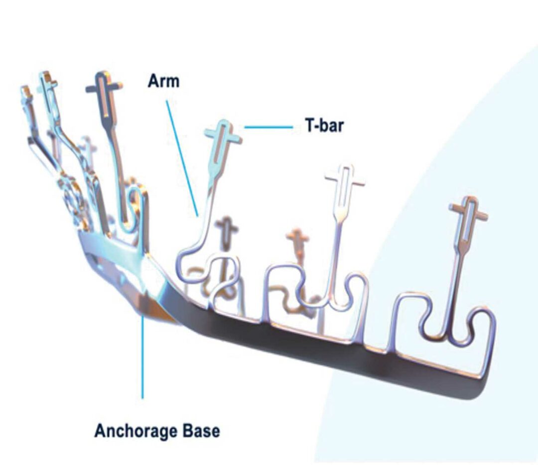Brava, a Novel Orthodontic System Resolves a Functional Shift