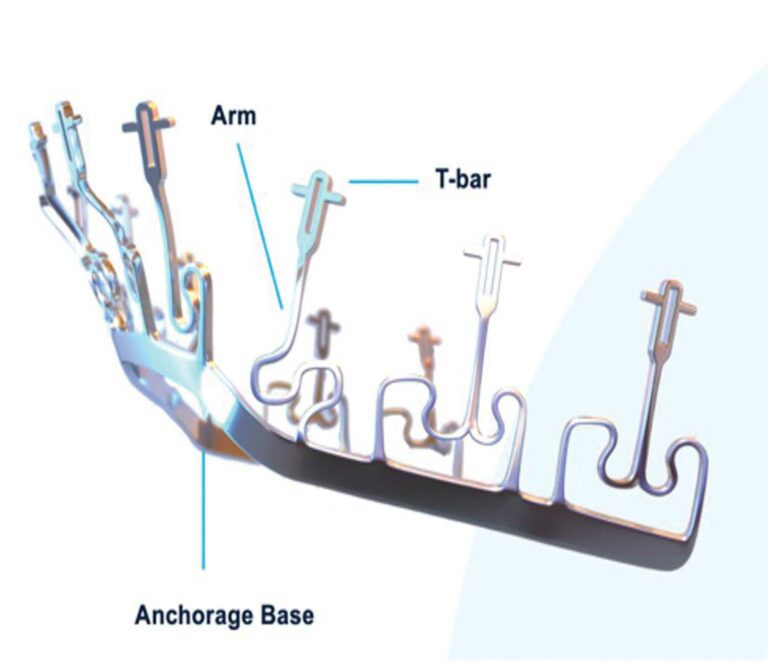 Brava, a Novel Orthodontic System Resolves a Functional Shift