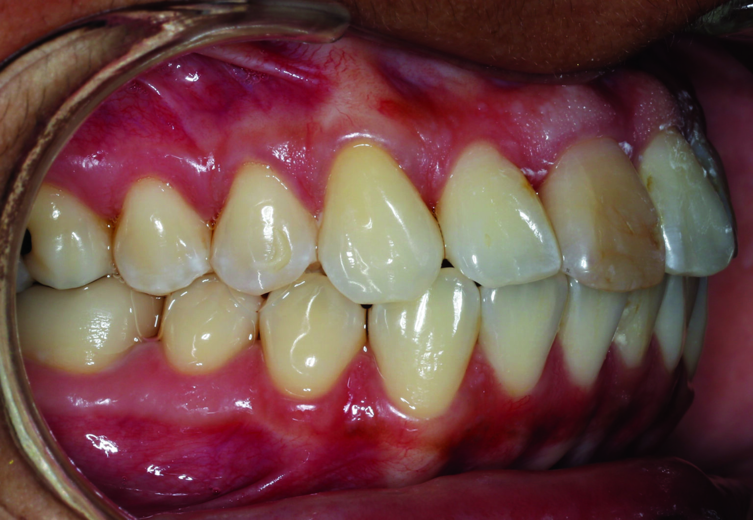 The InBrace System: Orthodontic Treatment on Autopilot