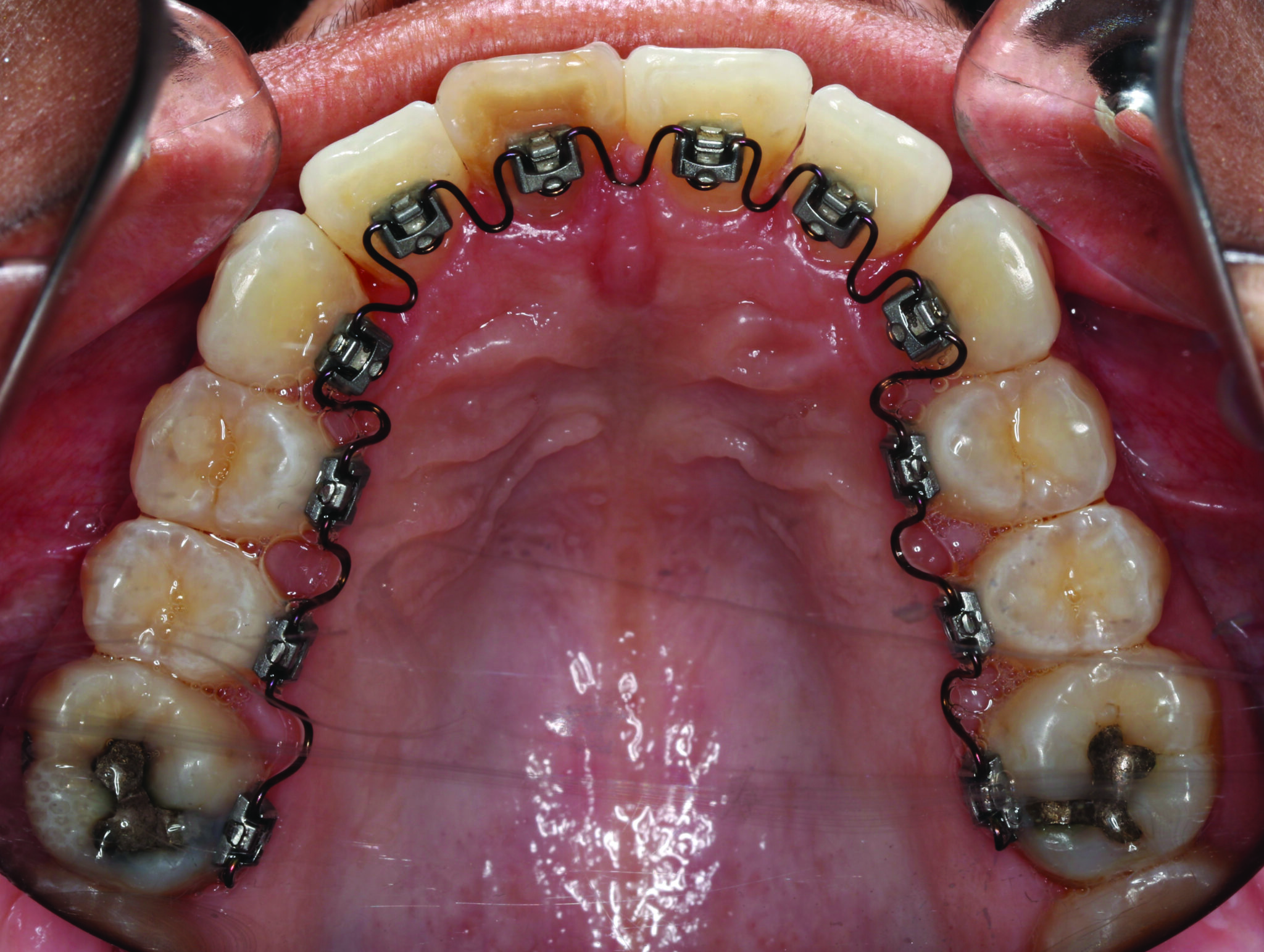 The InBrace System: Orthodontic Treatment on Autopilot