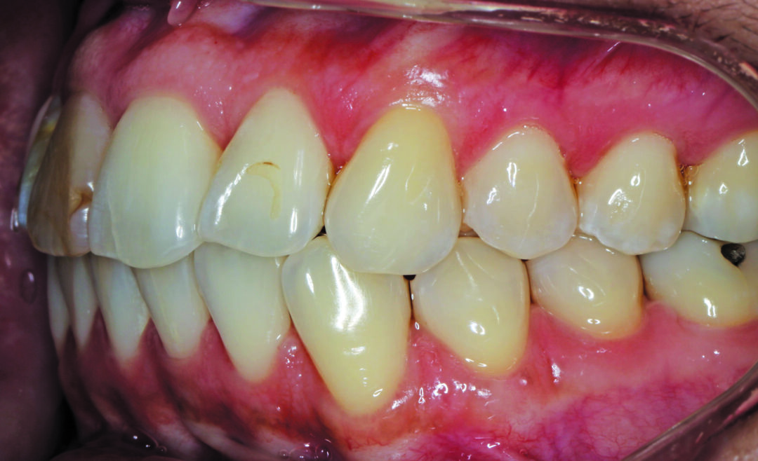 The InBrace System: Orthodontic Treatment on Autopilot