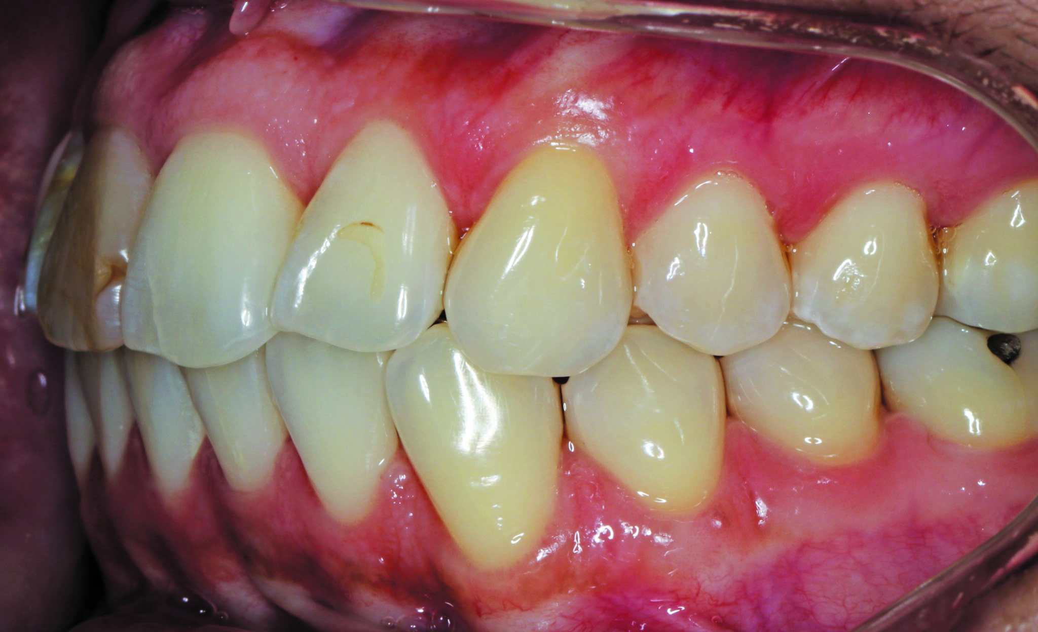 The InBrace System: Orthodontic Treatment on Autopilot