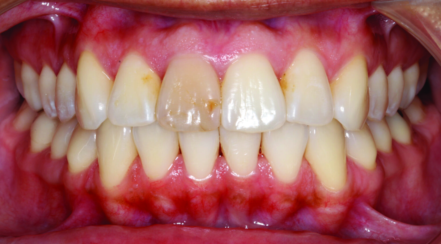 The InBrace System: Orthodontic Treatment on Autopilot