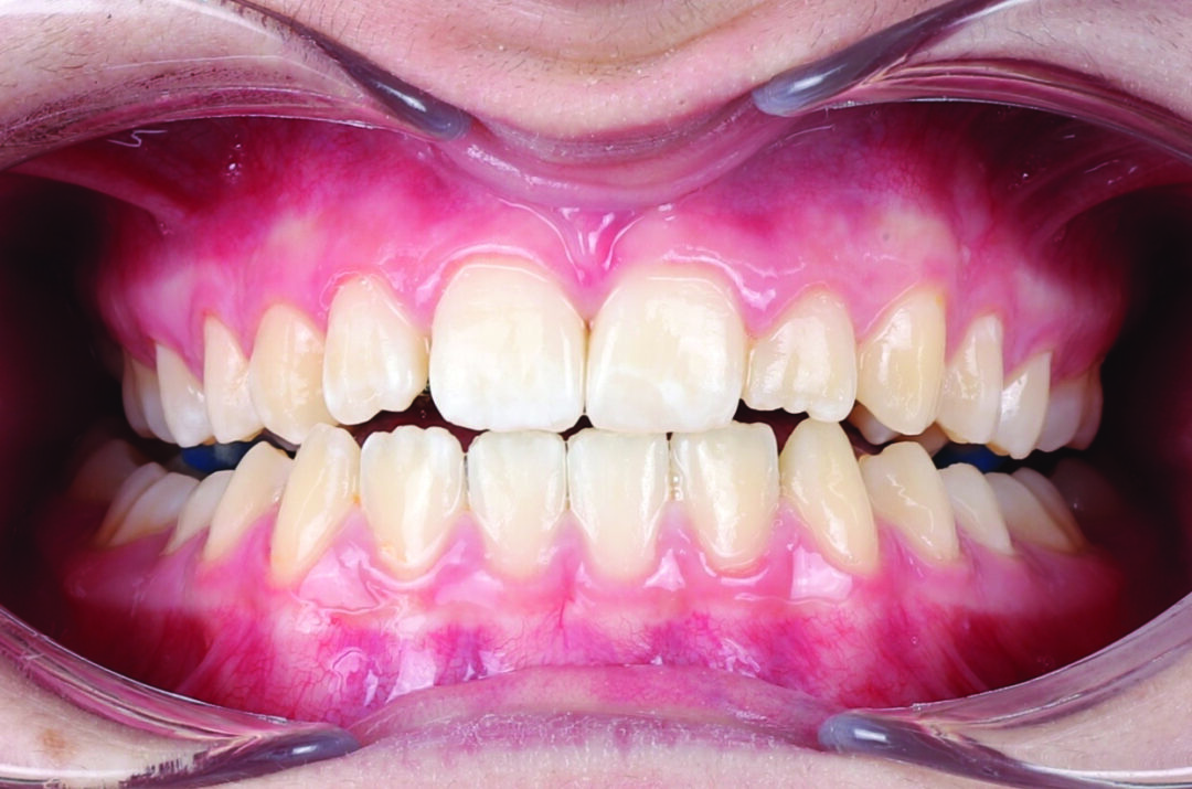 Brava, a Novel Orthodontic System Resolves a Functional Shift