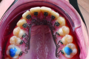 Brava, a Novel Orthodontic System Resolves a Functional Shift