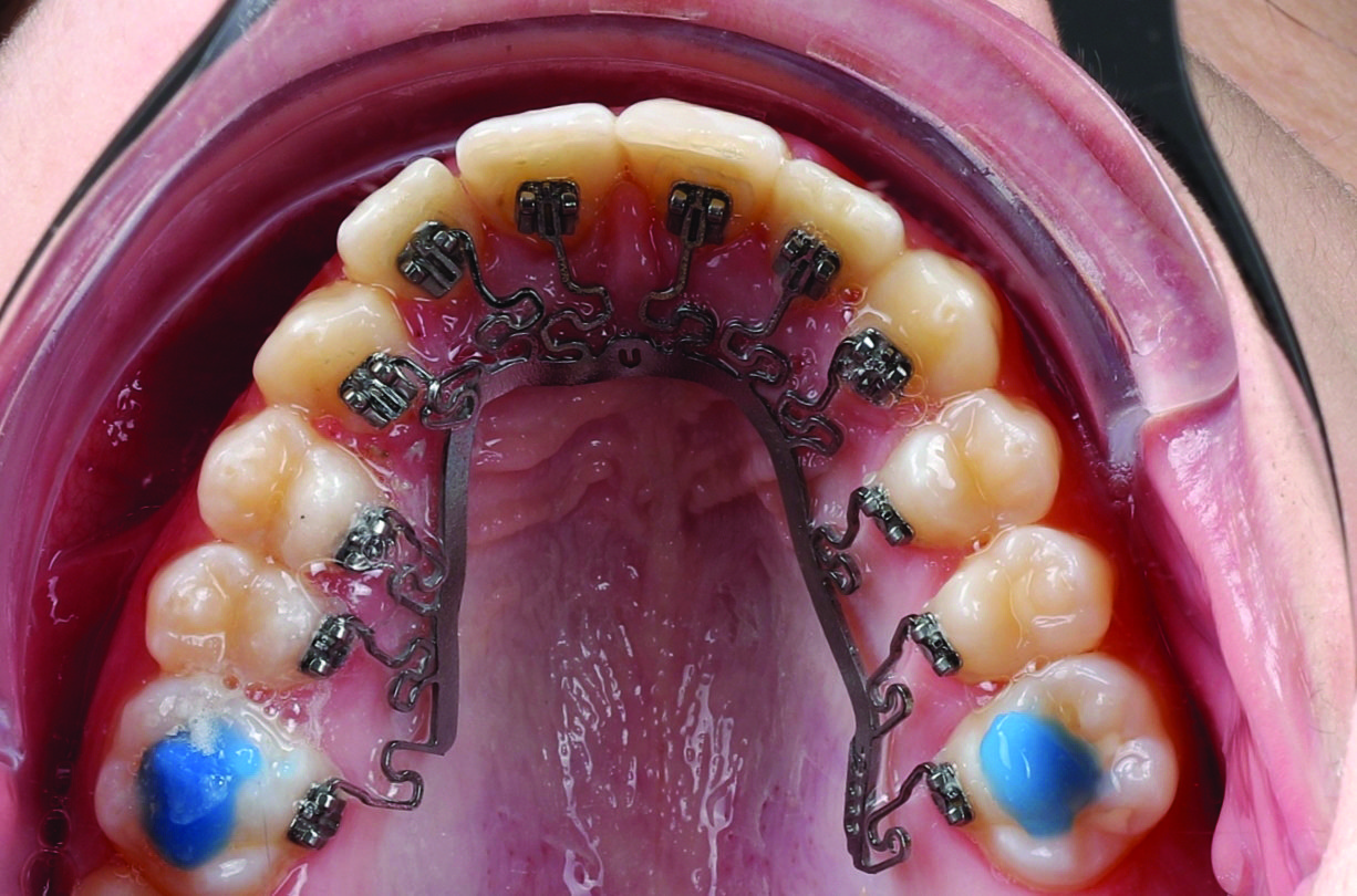 Brava, a Novel Orthodontic System Resolves a Functional Shift