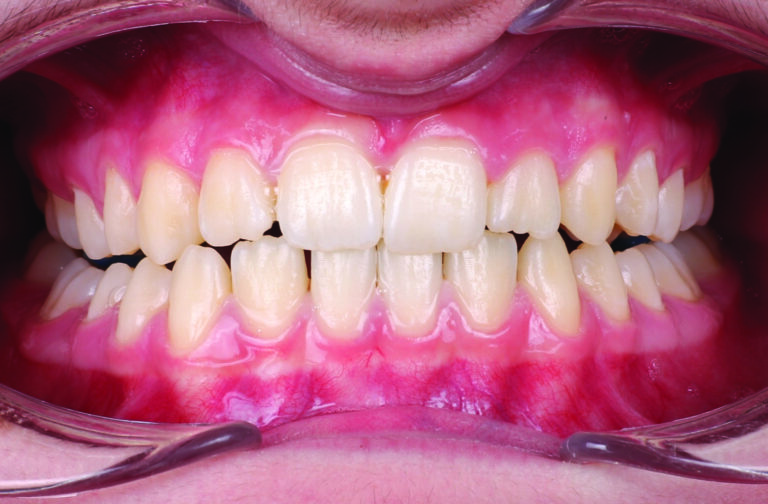 Brava, a Novel Orthodontic System Resolves a Functional Shift