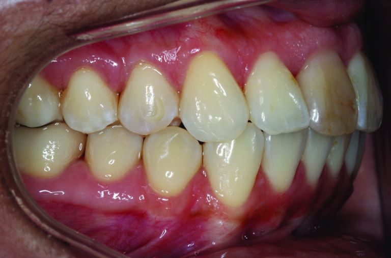 The InBrace System: Orthodontic Treatment on Autopilot