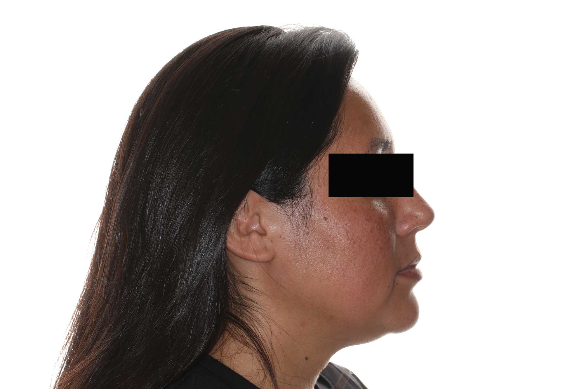 The InBrace System: Orthodontic Treatment on Autopilot