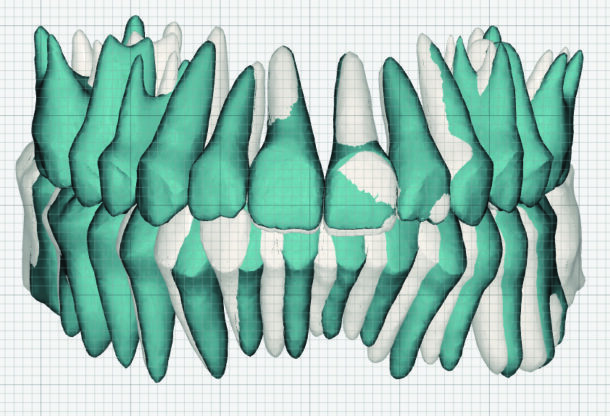 Brava, a Novel Orthodontic System Resolves a Functional Shift