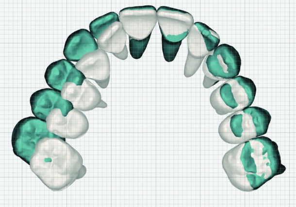 Brava, a Novel Orthodontic System Resolves a Functional Shift