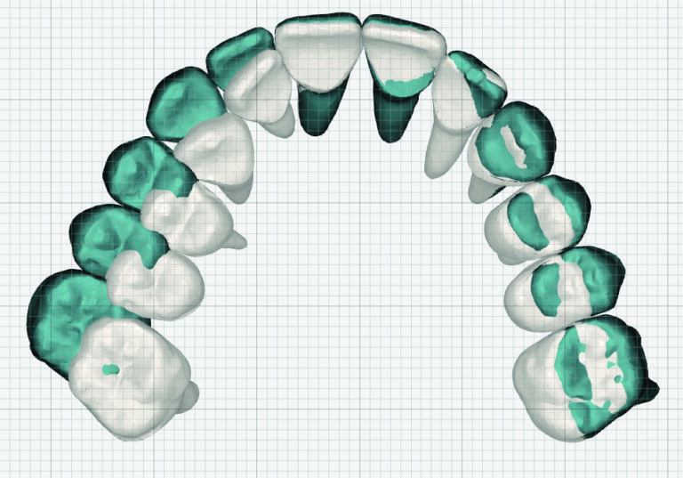 Brava, a Novel Orthodontic System Resolves a Functional Shift