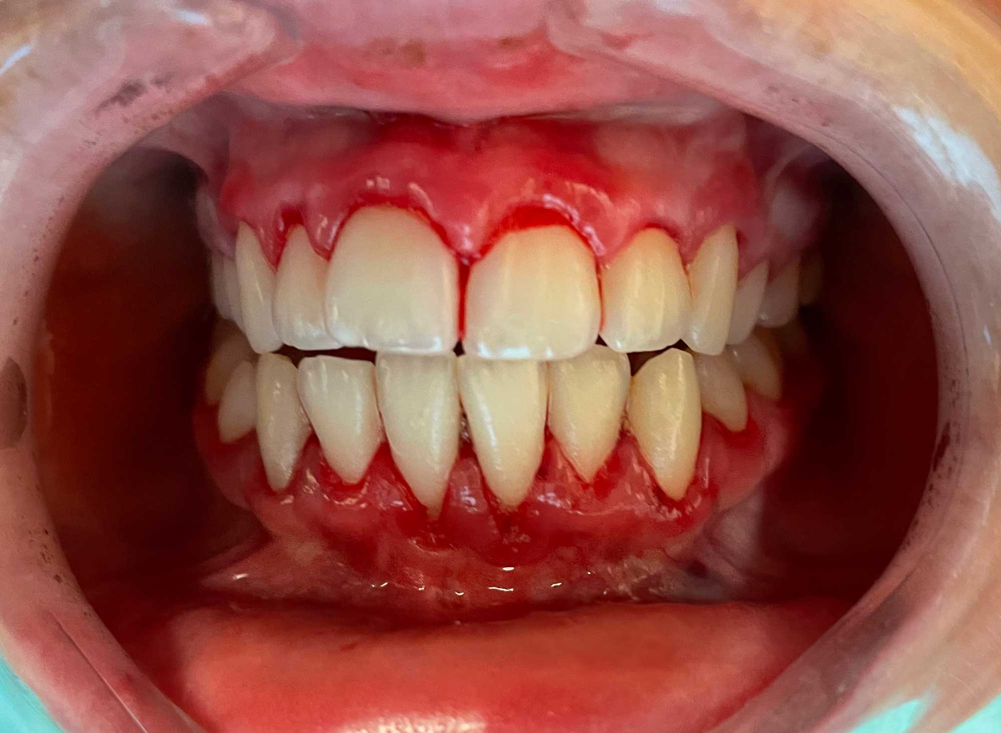 Incorporating the Latest Dental Lasers into the Orthodontic Practice