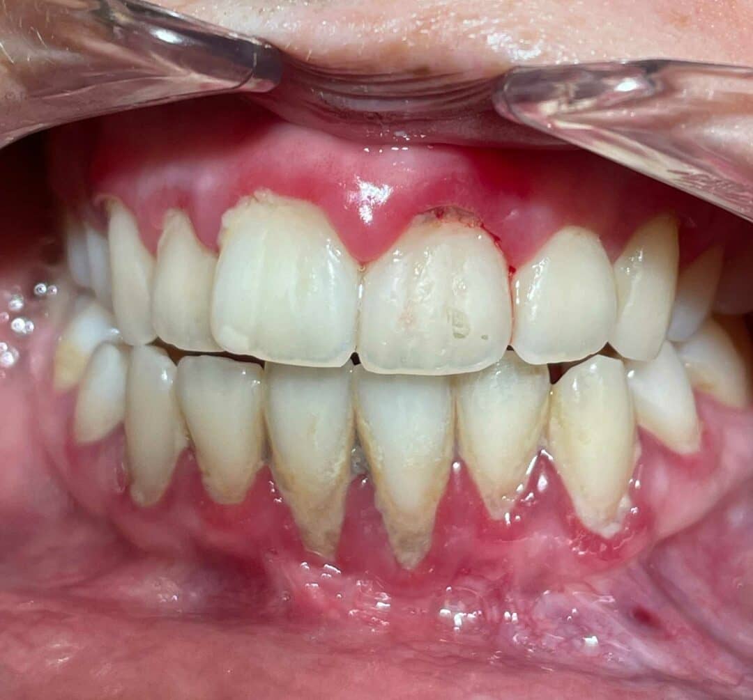 Incorporating the Latest Dental Lasers into the Orthodontic Practice