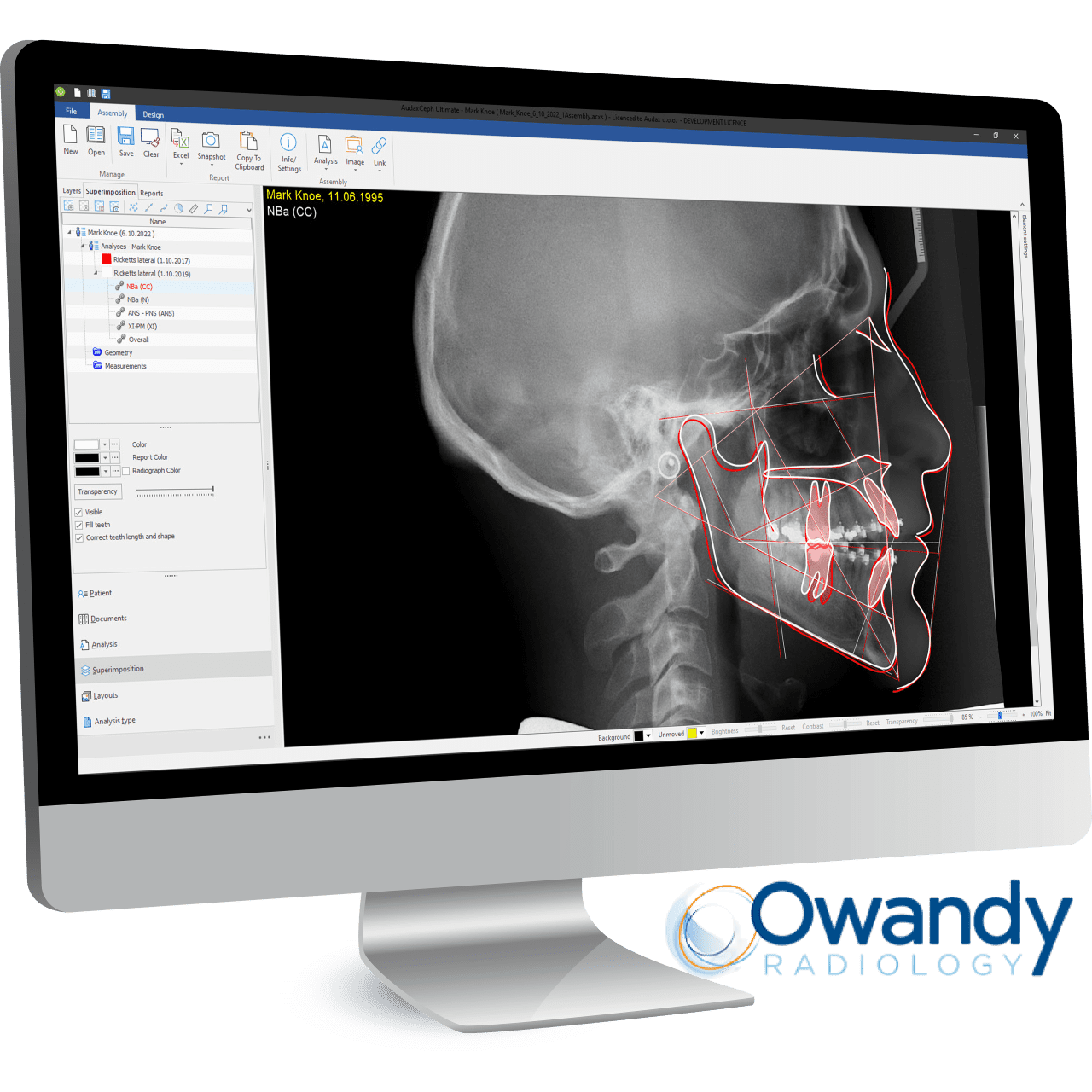 Owandy to Showcase AI Ceph Analysis Tool | Orthodontic Products