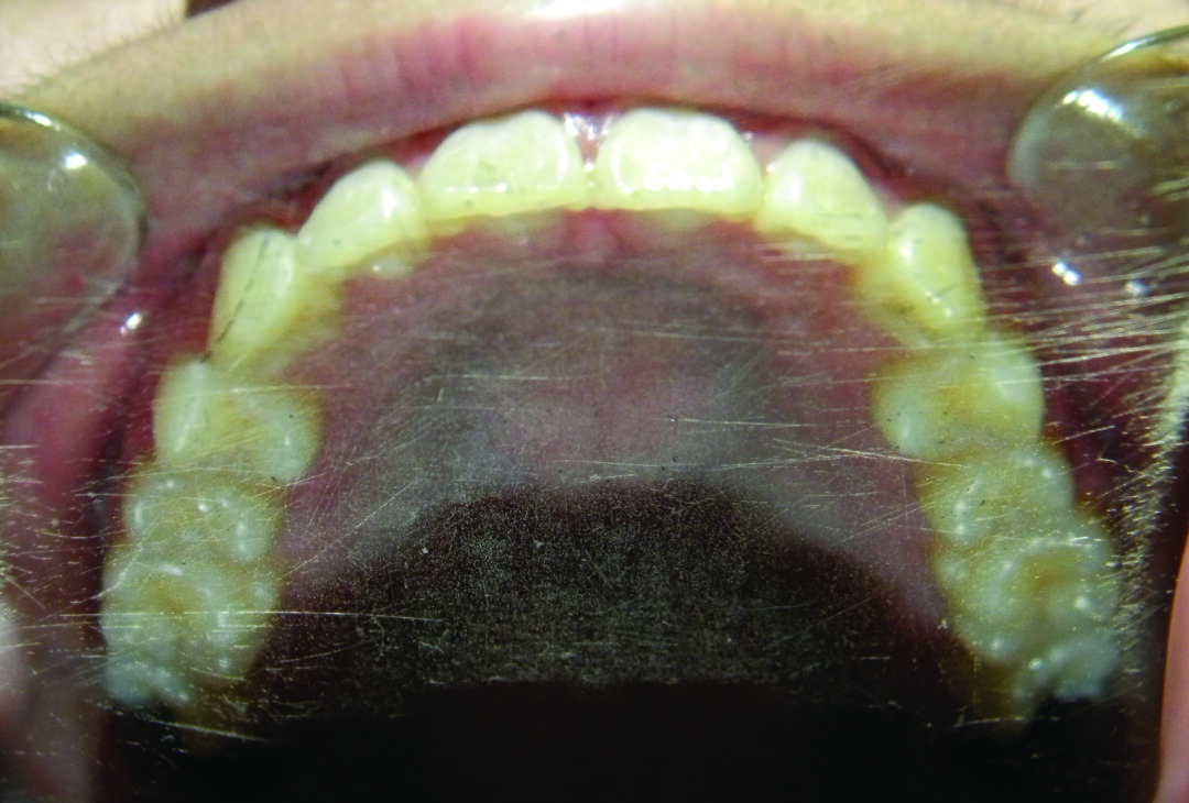 The Clear Difference: Achieving Fewer Refinements with Aligners