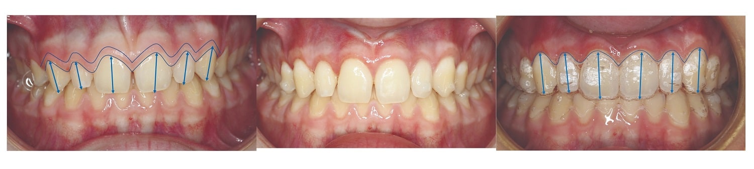 How Dental Lasers Allow for Better Adolescent Treatment | Orthodontic ...