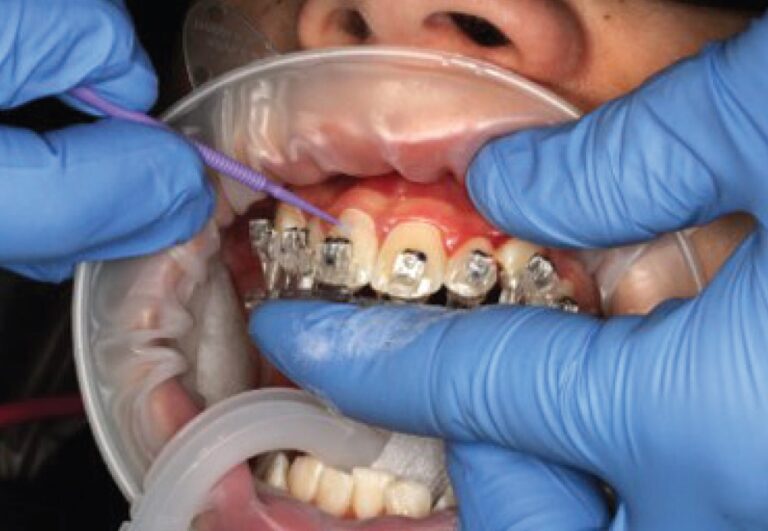 Merging Precision and Efficiency for Indirect Bonding | Orthodontic ...