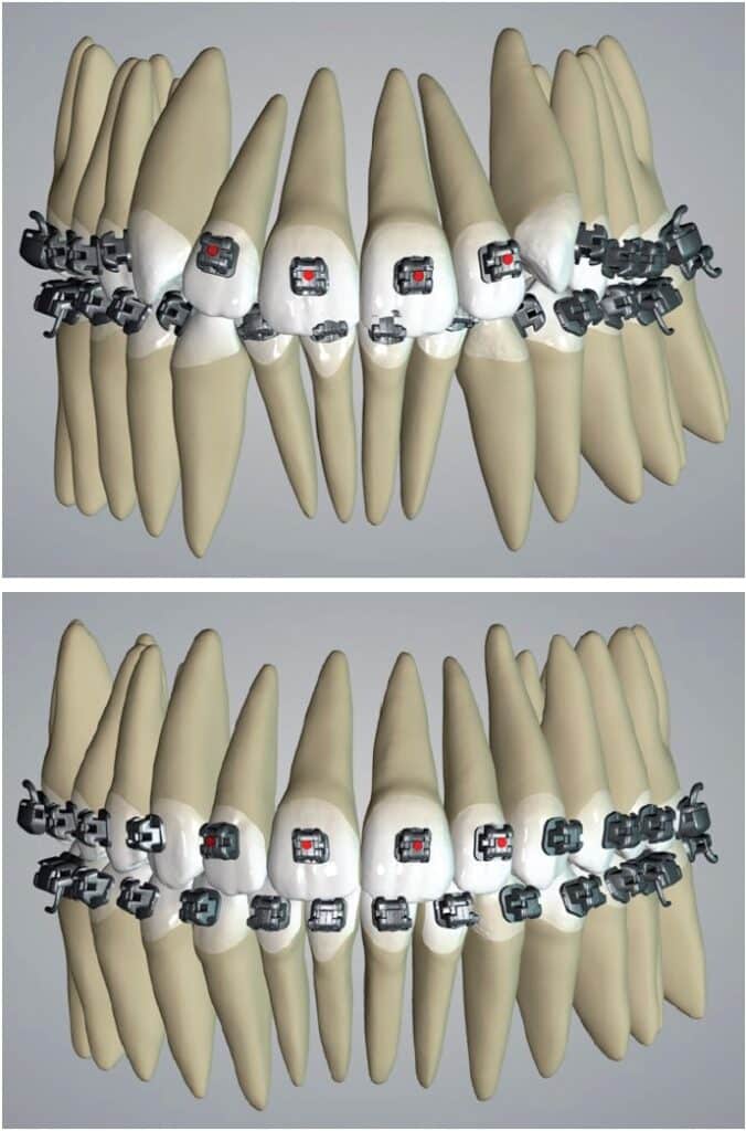 Merging Precision and Efficiency for Indirect Bonding | Orthodontic ...