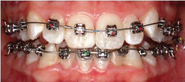 Merging Precision and Efficiency for Indirect Bonding | Orthodontic ...