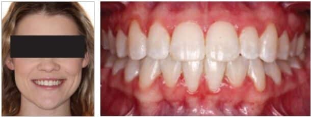 Merging Precision and Efficiency for Indirect Bonding | Orthodontic ...