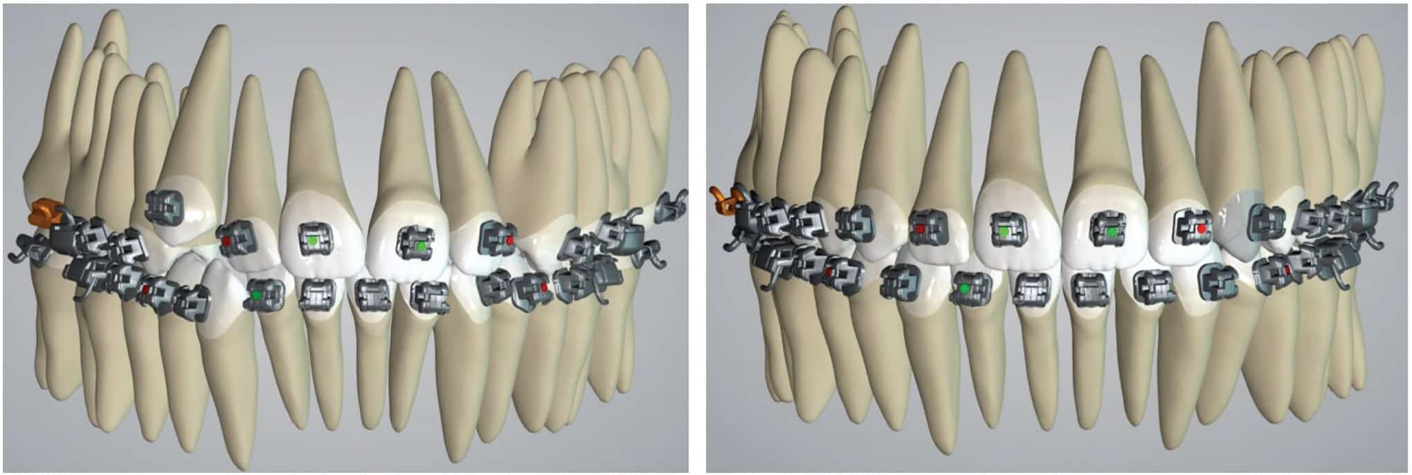 Merging Precision and Efficiency for Indirect Bonding | Orthodontic ...