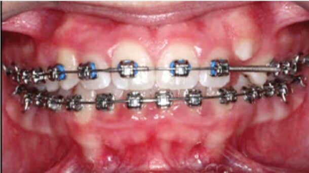 Merging Precision and Efficiency for Indirect Bonding | Orthodontic ...