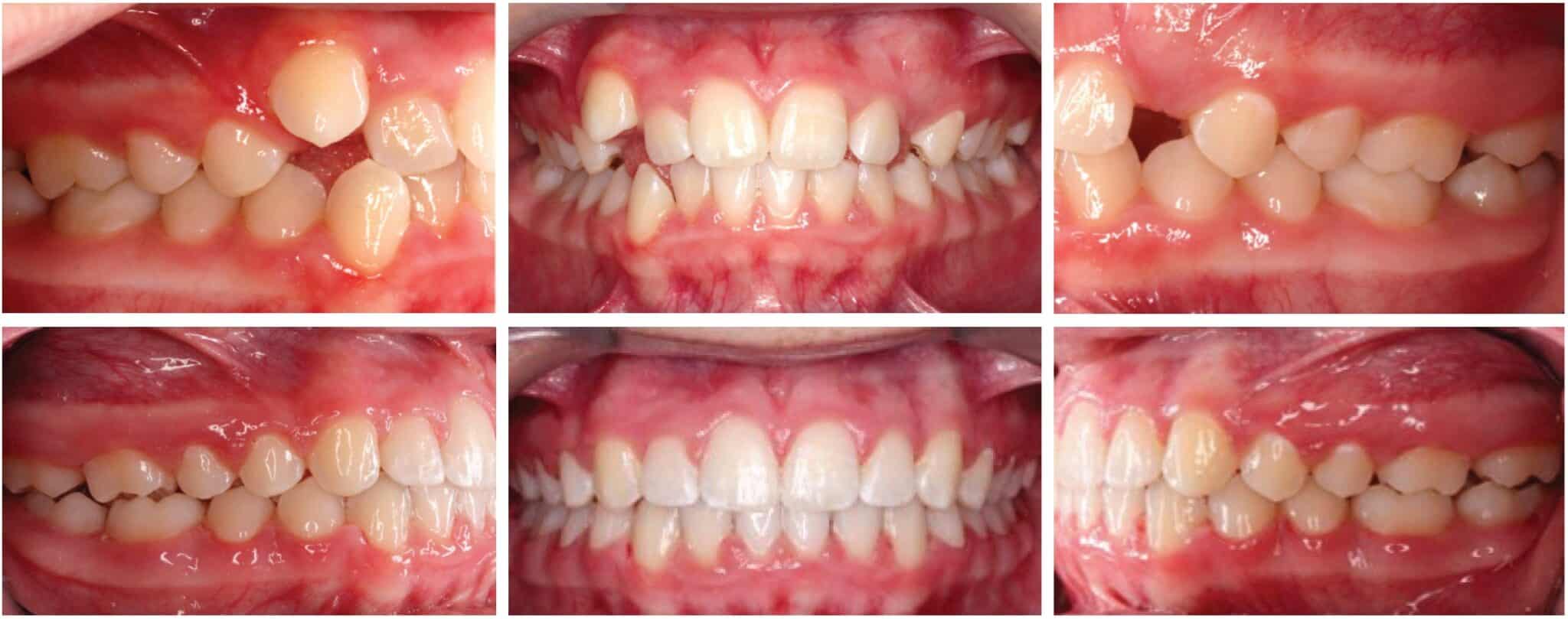 Merging Precision and Efficiency for Indirect Bonding | Orthodontic ...