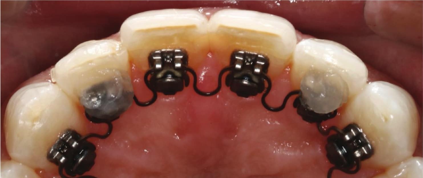 The 10 Commandments of InBrace Treatment | Orthodontic Products