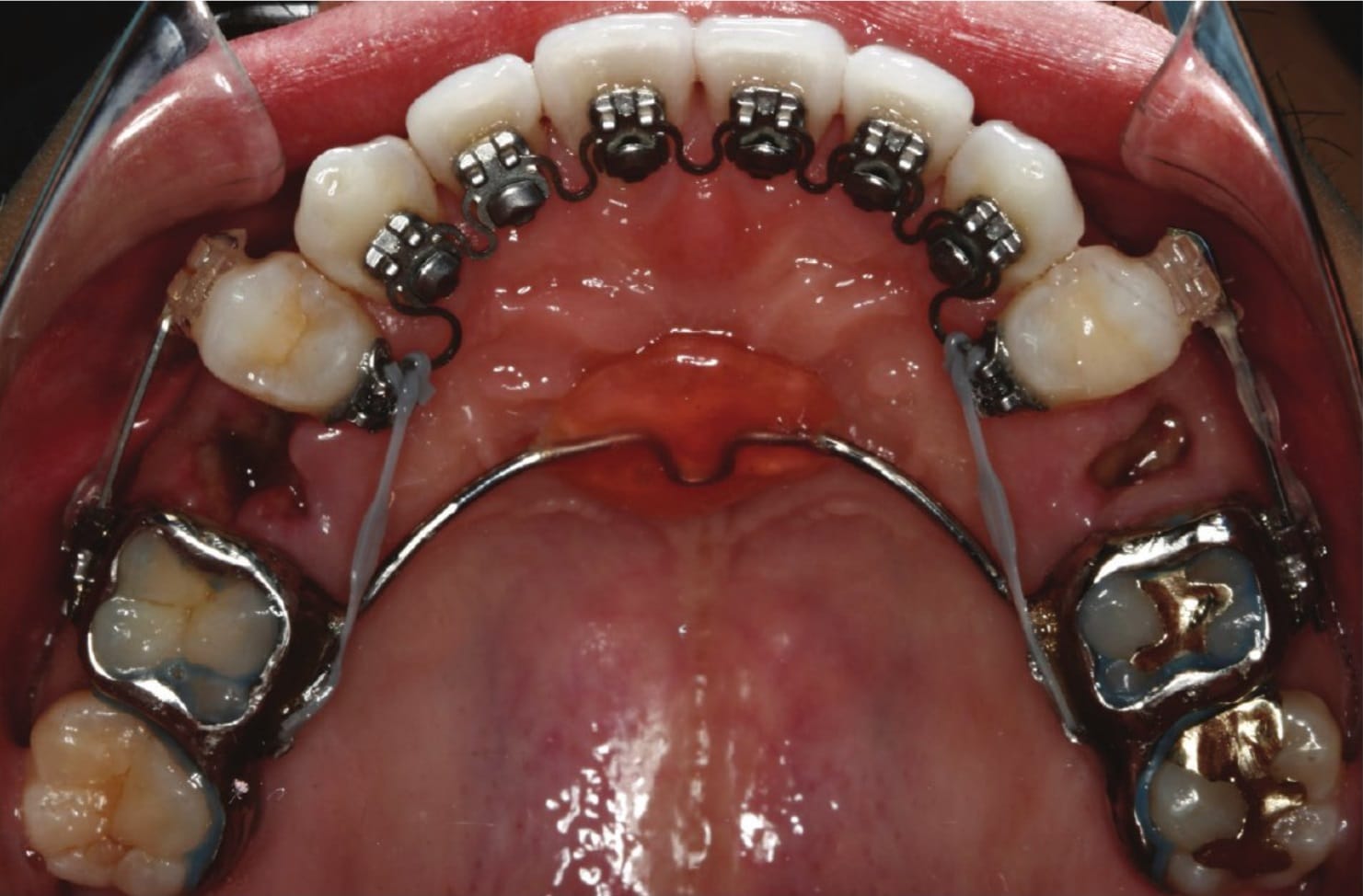 The 10 Commandments of InBrace Treatment | Orthodontic Products