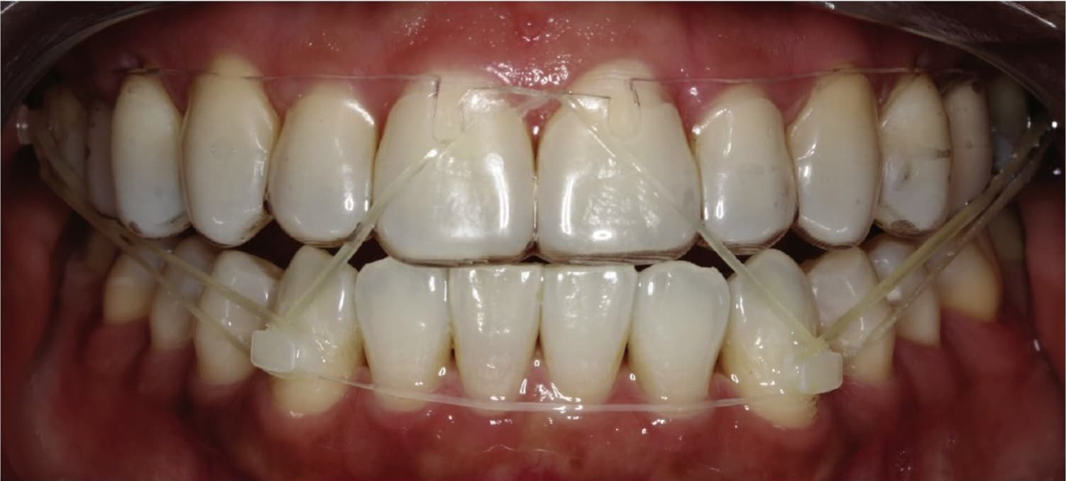 The 10 Commandments of InBrace Treatment | Orthodontic Products