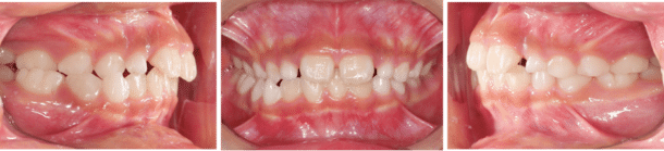 Digital Expansion with the Invisalign Palatal Expander