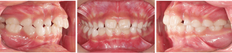 Digital Expansion with the Invisalign Palatal Expander