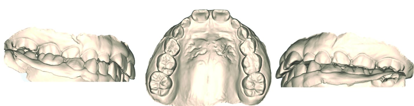 Digital Expansion with the Invisalign Palatal Expander