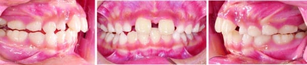 Digital Expansion with the Invisalign Palatal Expander
