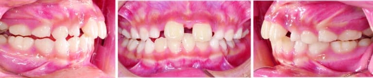 Digital Expansion with the Invisalign Palatal Expander