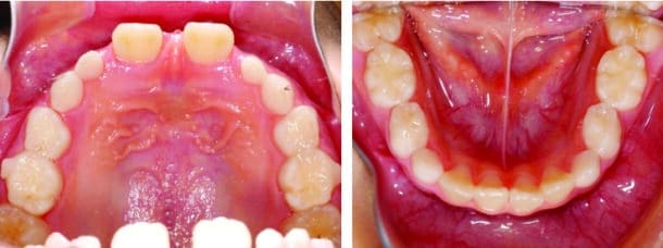 Digital Expansion with the Invisalign Palatal Expander