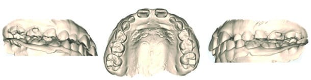 Digital Expansion with the Invisalign Palatal Expander