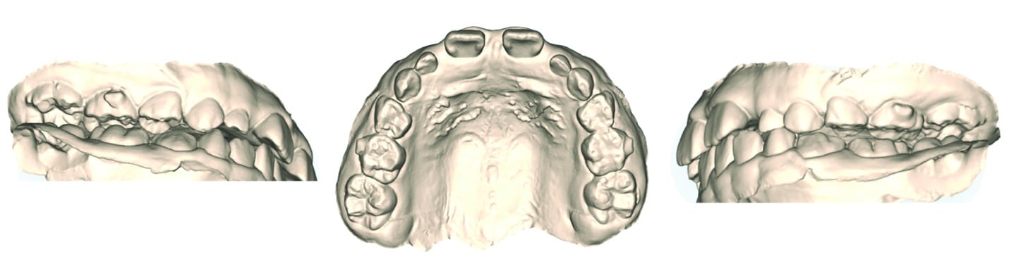 Digital Expansion with the Invisalign Palatal Expander