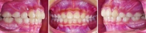 Digital Expansion with the Invisalign Palatal Expander