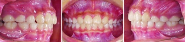 Digital Expansion with the Invisalign Palatal Expander