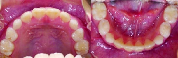 Digital Expansion with the Invisalign Palatal Expander