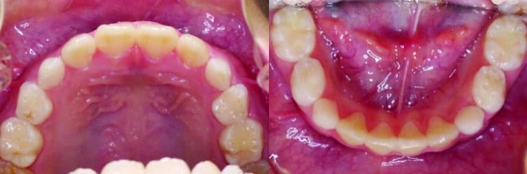 Digital Expansion with the Invisalign Palatal Expander