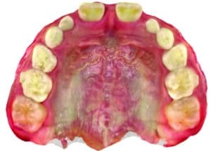 Digital Expansion with the Invisalign Palatal Expander