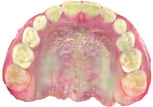 Digital Expansion with the Invisalign Palatal Expander