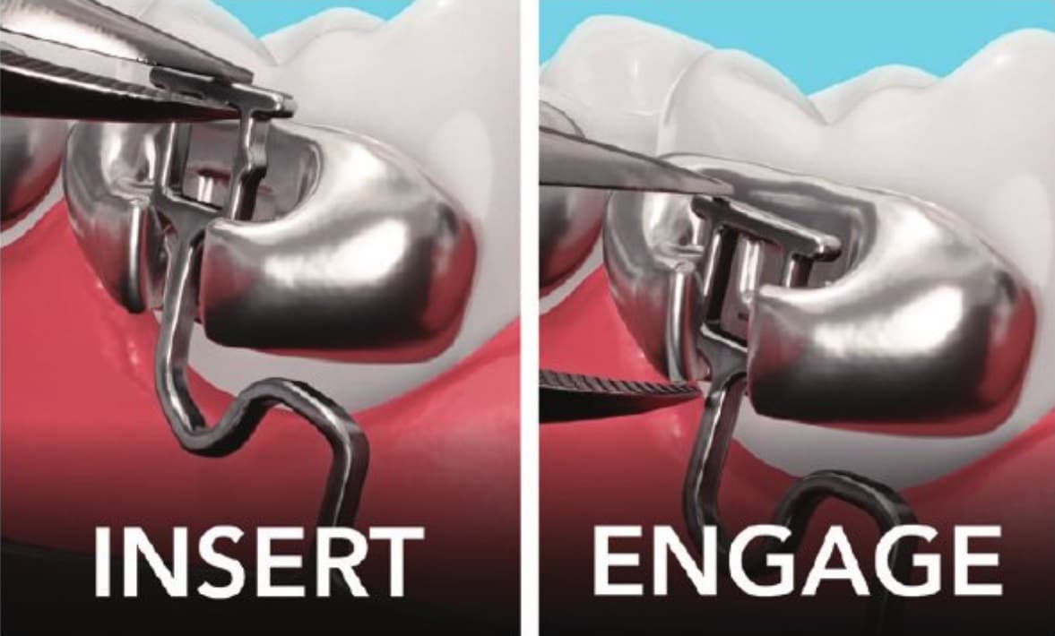 What’s New in Brackets for 2024 | Orthodontic Products