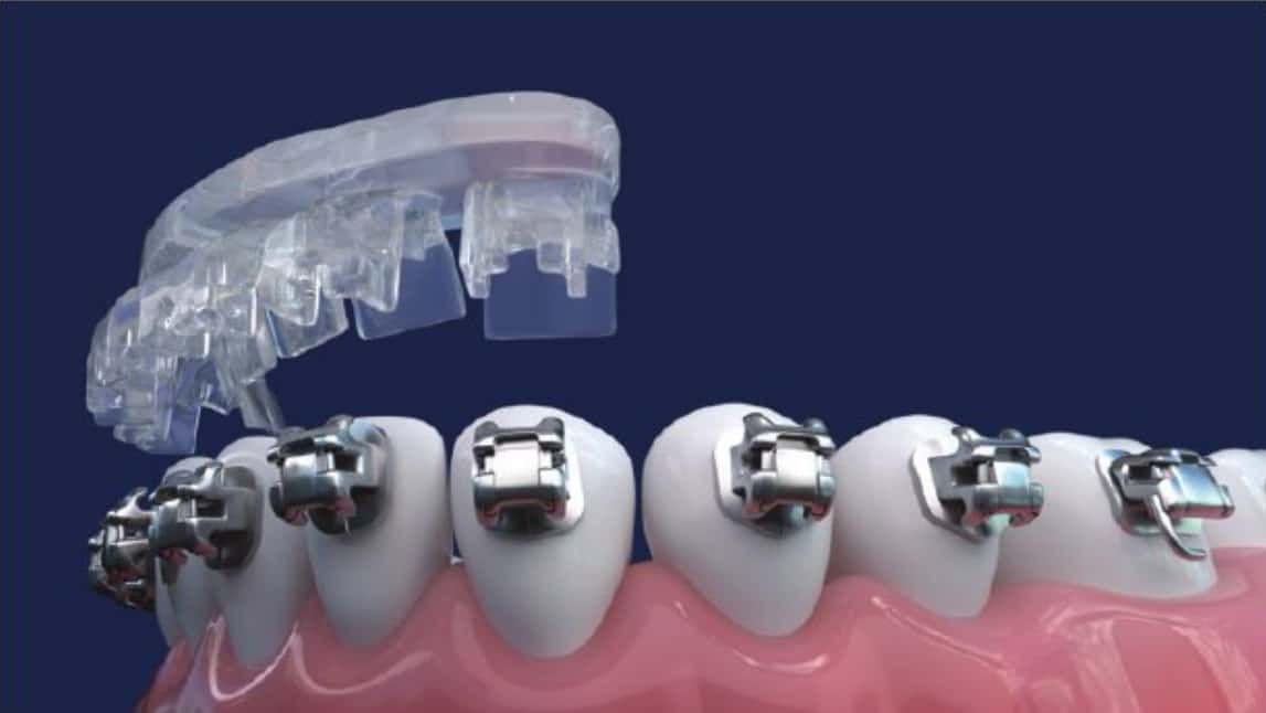 What’s New in Brackets for 2024 | Orthodontic Products